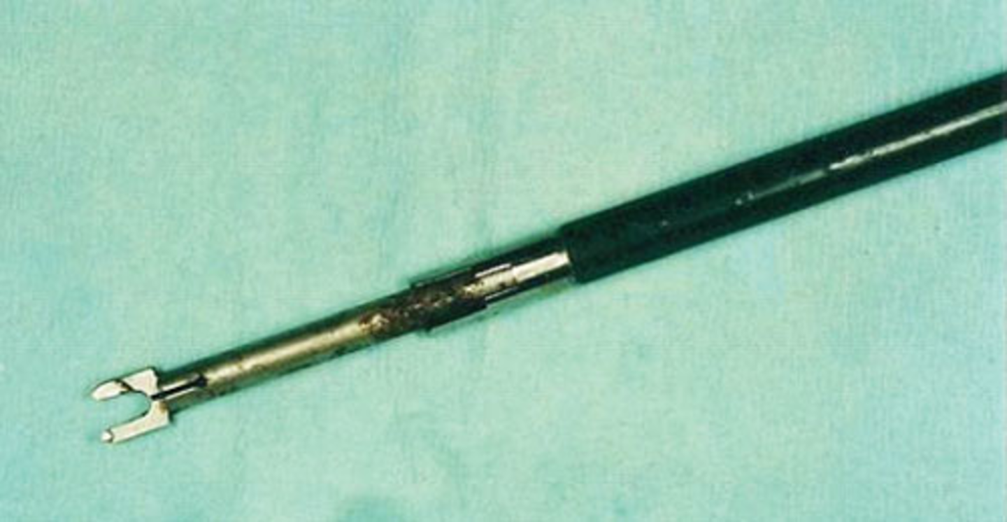 Narrating the pathogenesis of a deep organ surgical infection ...