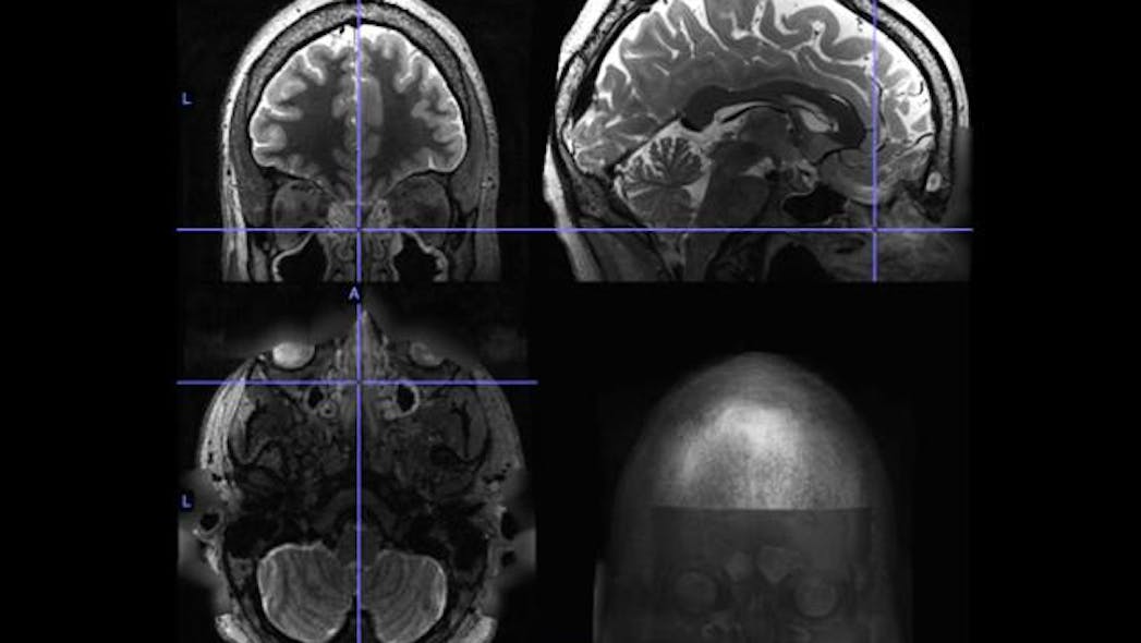 Chronic sinus inflammation appears to alter brain activity | Healthcare ...
