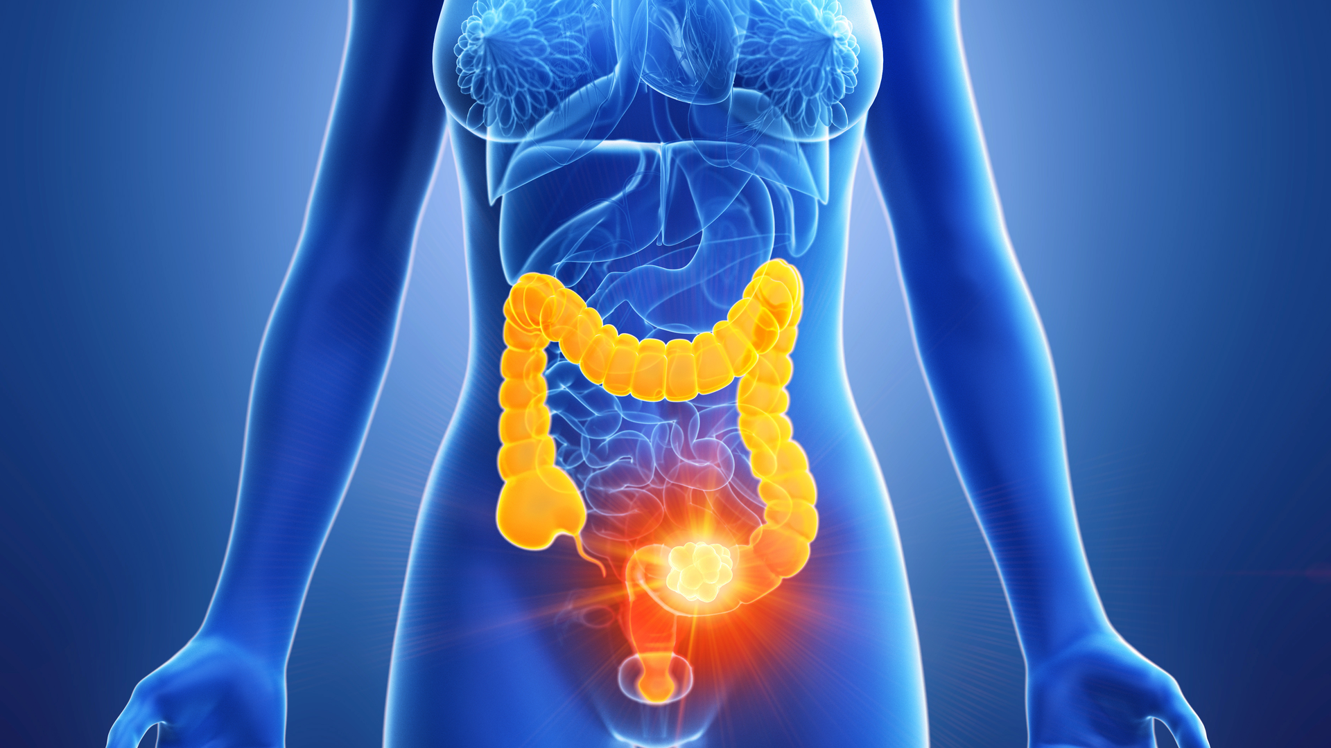 Immunotherapy treatment replaces surgery and chemotreatment of rectal ...