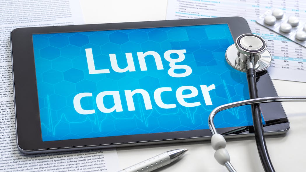Lung cancer risk predicted with new artificial intelligence tool ...