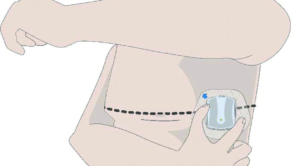 Wearable device provides early warning of heart failure | Healthcare ...